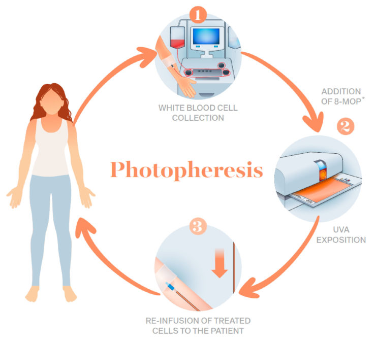 Biotherapy : photopheresis, cell-culture, Bio-Banking, Cord-Blood